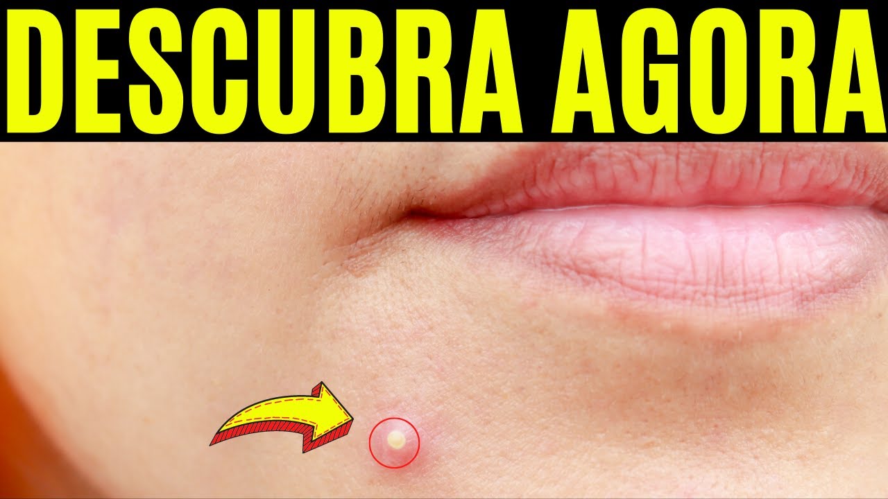 Espinha Perto da Boca o Que Significa - Causas - Prevenção - O que ...