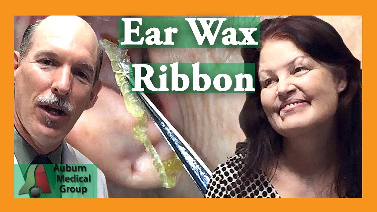 LONGEST Ear Wax Ribbon | Auburn Medical Group - YouTube