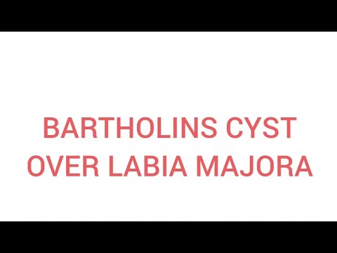 BARTHOLINS CYST OVER LABIA MAJORA - YouTube