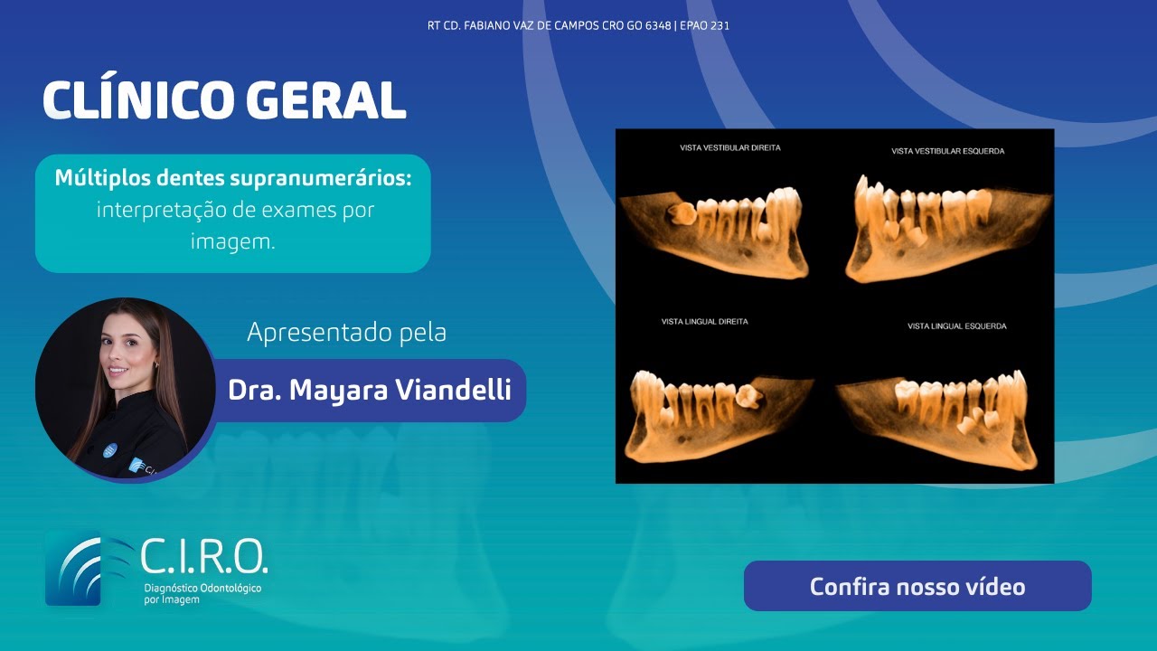 Múltiplos dentes supranumerários: interpretação de radiografia ...