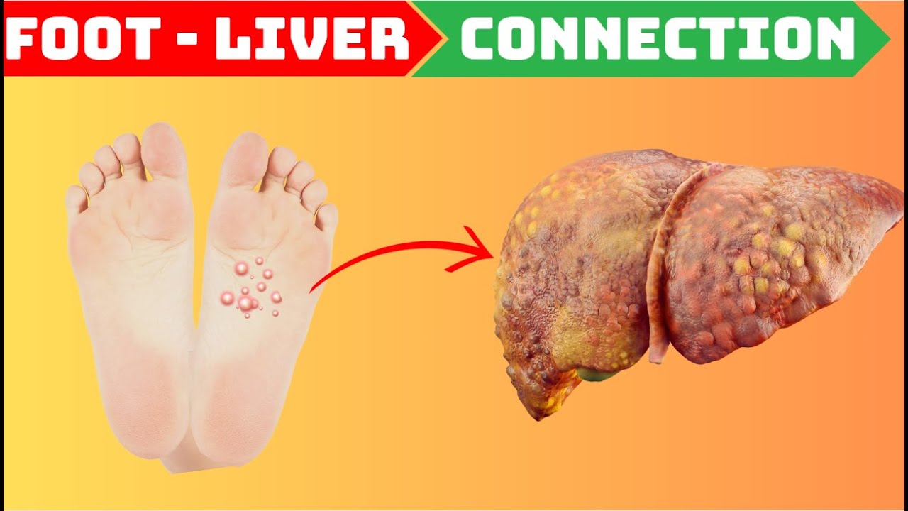 How Your Feet Are Warning You About Your Liver Problems? - YouTube