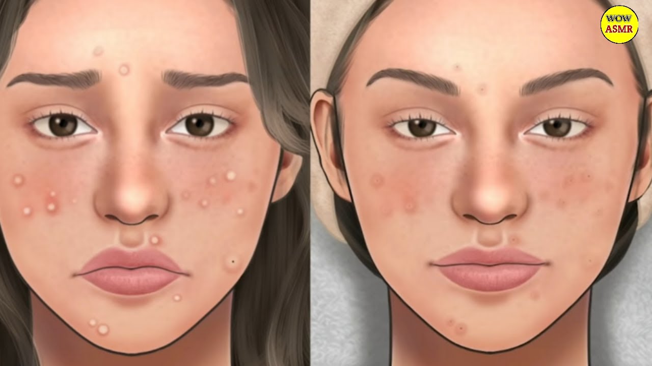 Pimples deep cleaning asmr animation black hands#asmr #animation # ...