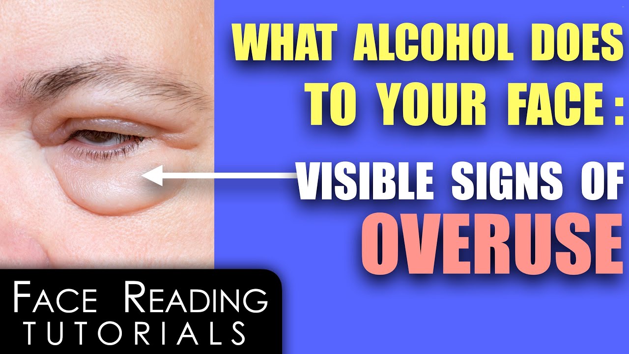 What Alcohol Does To Your Face: Visible Signs of Overuse - YouTube