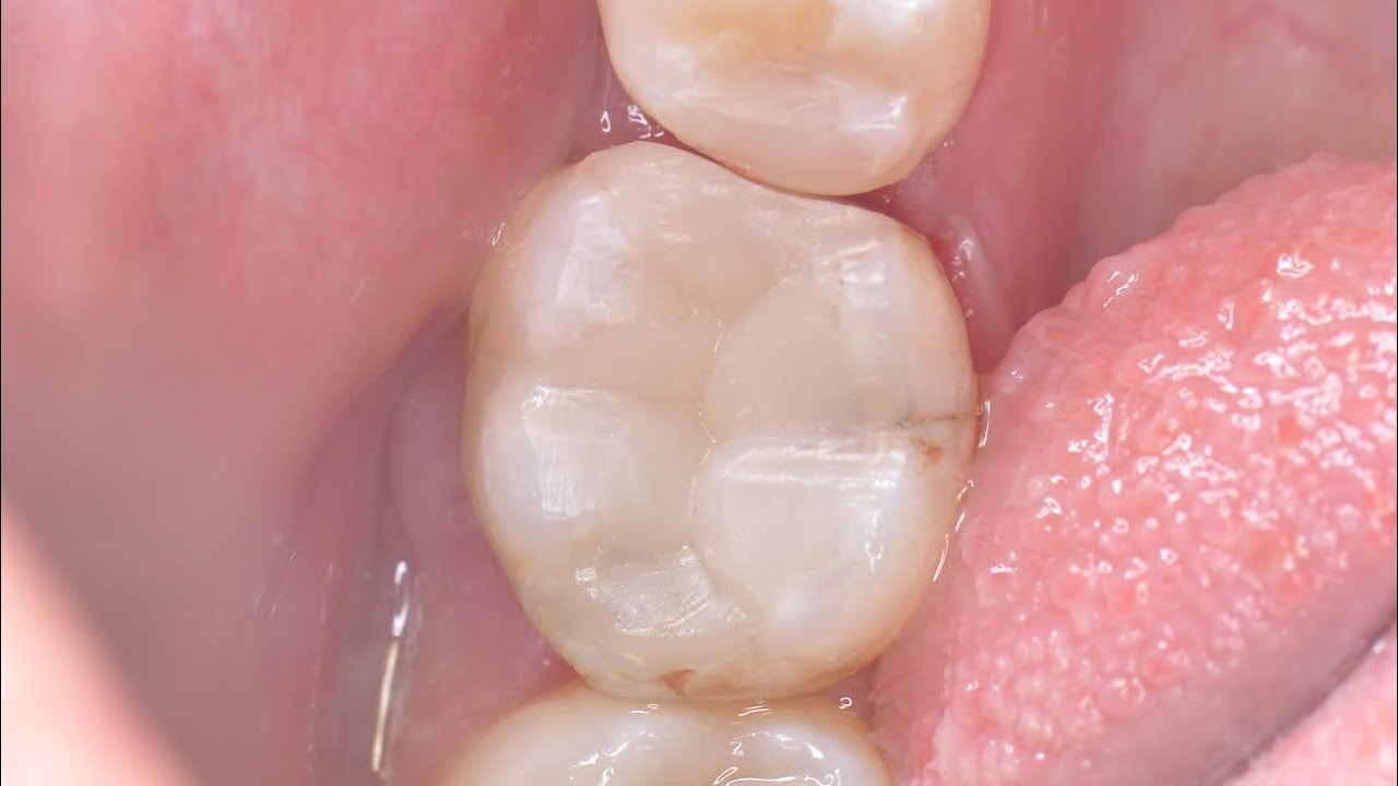 Root canal treatment on lower molar. ( normal speed) - YouTube