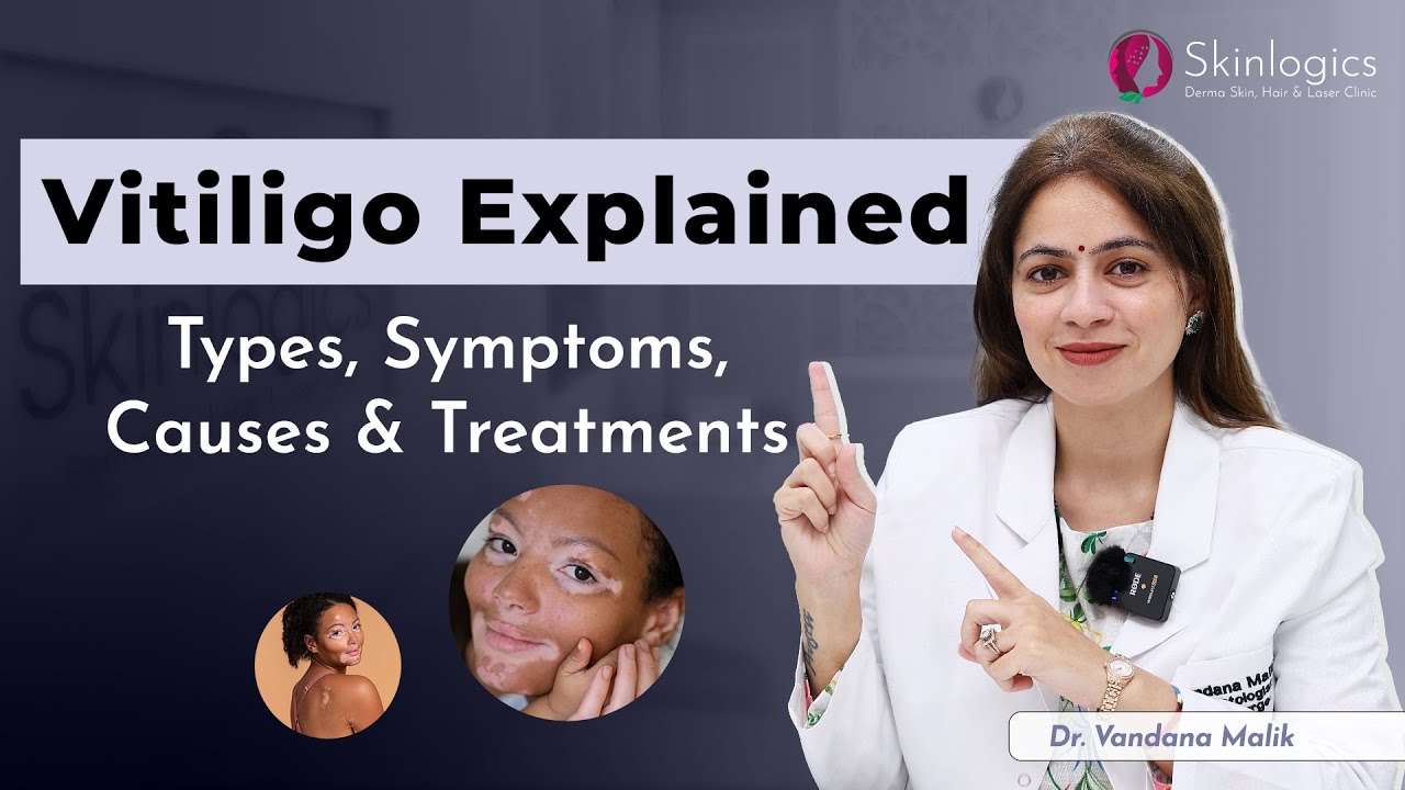 Vitiligo/Leucoderma | Causes and Treatment | Best Skin Specialist in ...