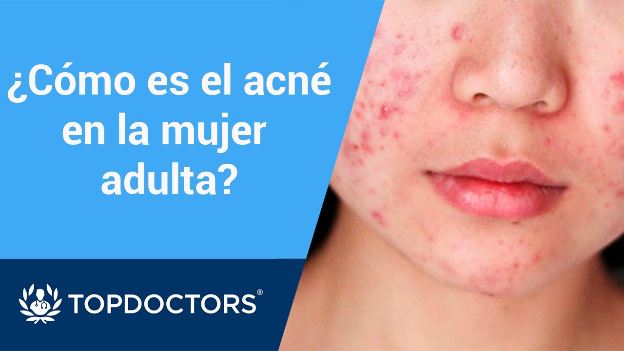 ¿Cómo es el acné en la mujer adulta? - Dr. Pablo de la Cueva (2/4 ...