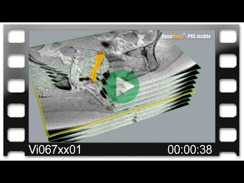 DynaMesh® MRI - Animation: MRI Reconstruction with DynaMesh®-PRS ...