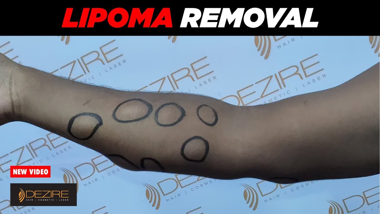Multiple Lipoma Removal | Watch This Life-Changing Lipoma Removal By Dr ...