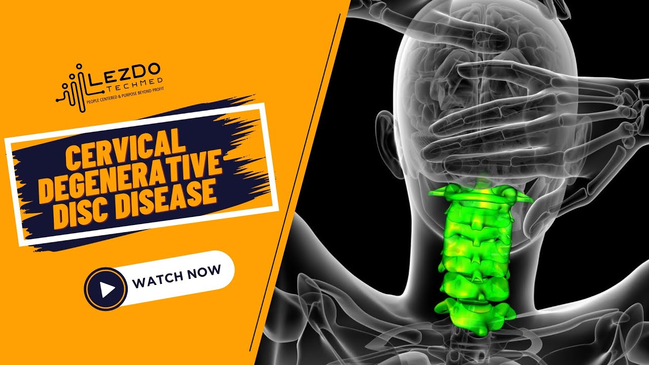 Cervical Degenerative Disc Disease Youtube