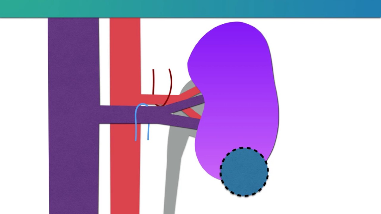 NEFRECTOMIA PARCIAL LAPAROSCÓPICA • LAPAROSCOPIC PARTIAL NEPHRECTOMY ...