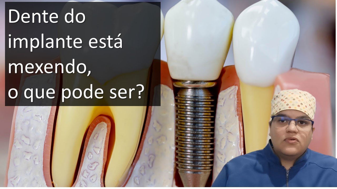 O dente com implante está mole o que fazer? | Dra Bianca Rosa | Master ...