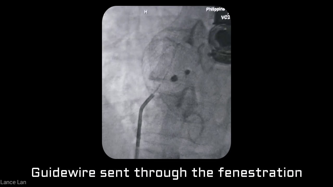 Transcatheter Closure of the Fenestration in Cera Fenestrated ASD ...