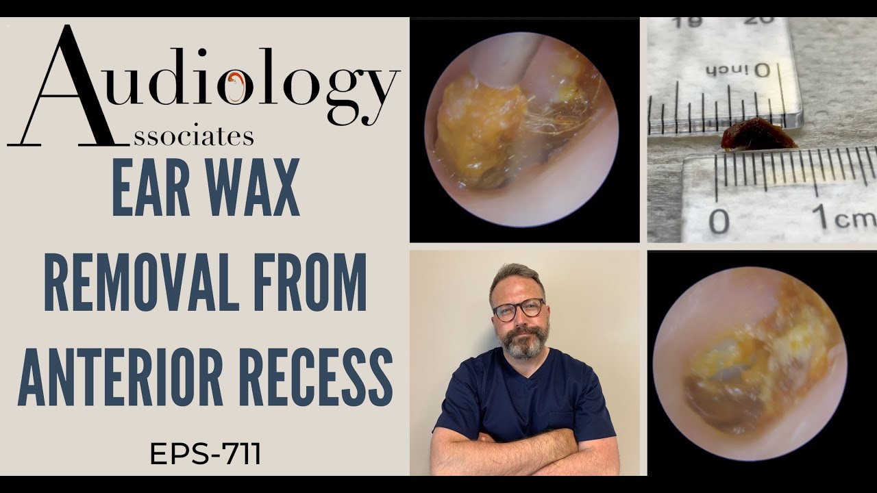 EAR WAX REMOVAL FROM THE ANTERIOR RECESS - EP711 - YouTube