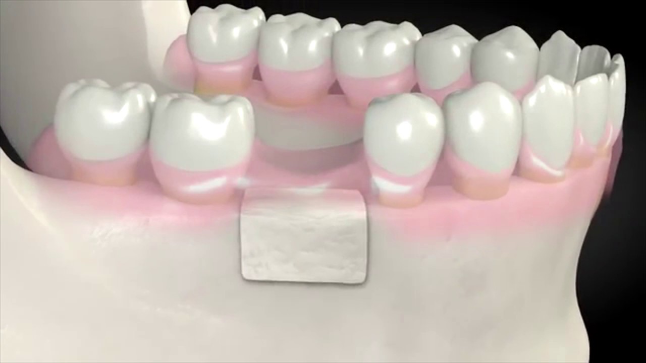 Bone Grafting Purpose & Benefits (2017 TV SEGMENT) - YouTube