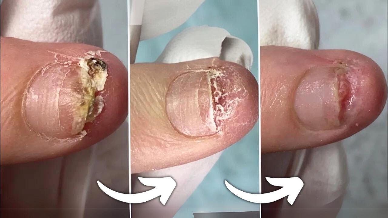 Transformação da Unha ️ Como Recuperar a Unha Após uma Lesão 🔥 Parte 2 ...