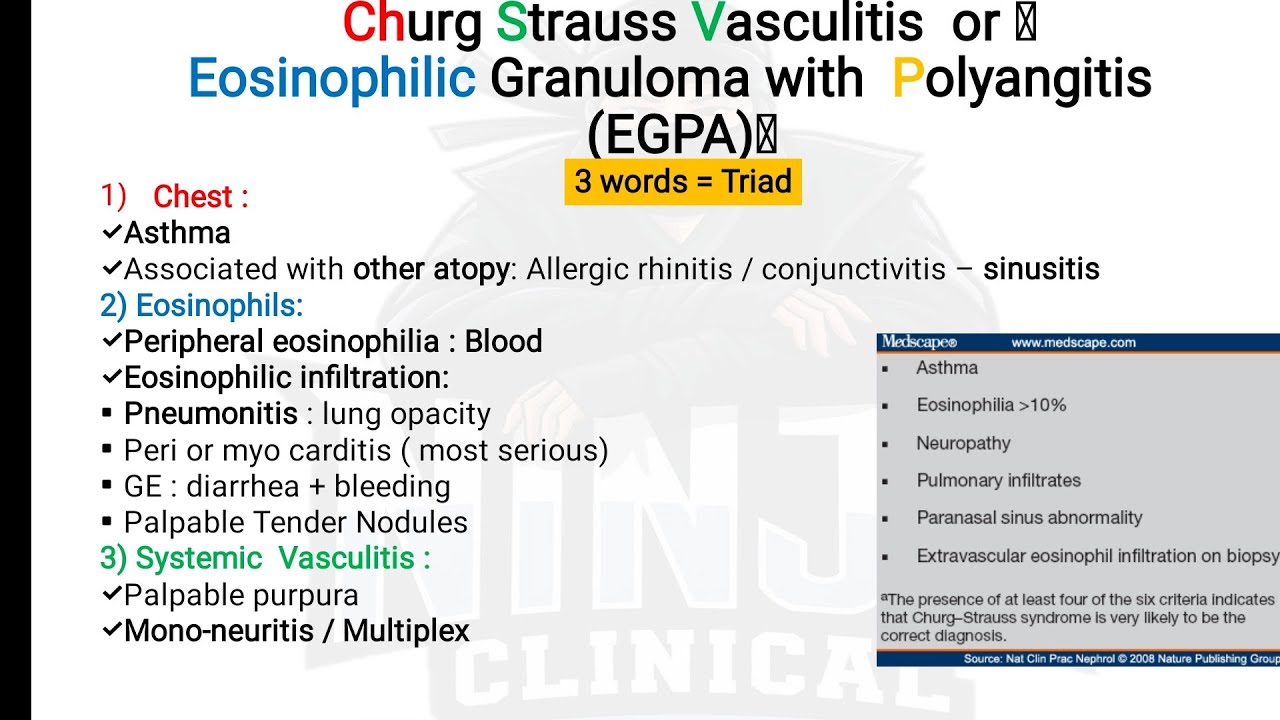 3- P-ANCA associated vasculitis ( churg strauss syndrome - microscopic ...