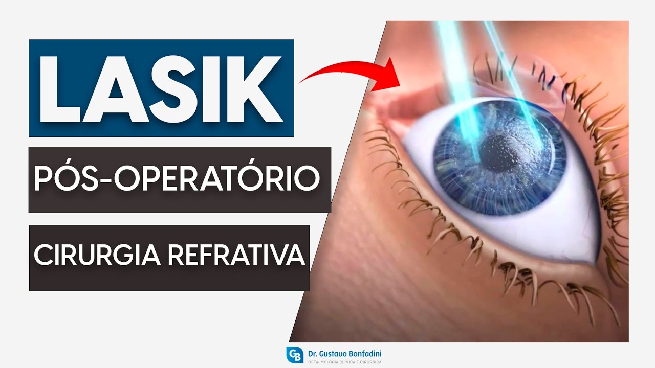 Cirurgia refrativa LASIK: recuperação no pós-operatório - Dr. Gustavo ...