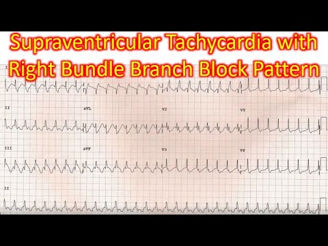 Supraventricular Tachycardia with Right Bundle Branch Block Pattern ...