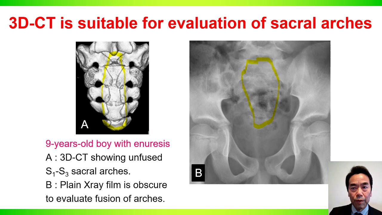 ICS 2020 Abstract #497 High prevalence of dysplastic development of ...