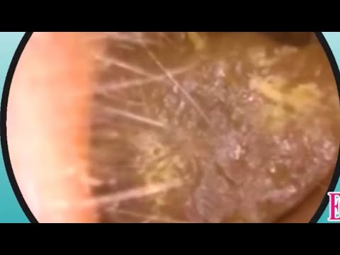 What is the fastest way to heal a perforated eardrum? - Healthy_of_Ear ...