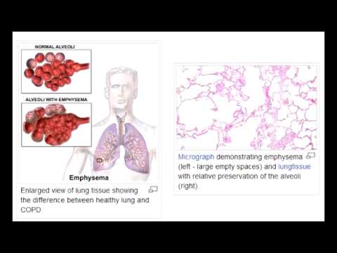 Emphysema - "Pink Puffer" - Centriacinar & Panacinar - YouTube
