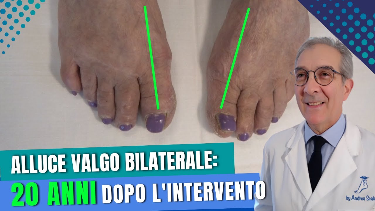 Alluce valgo bilaterale: 20 anni dopo l'intervento | Testimonianze ...