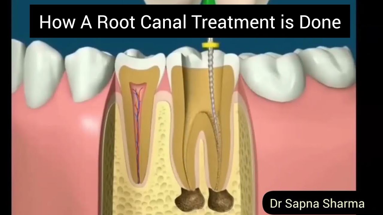 Root Canal Procedure Explained through Animation | How a Root Canal ...