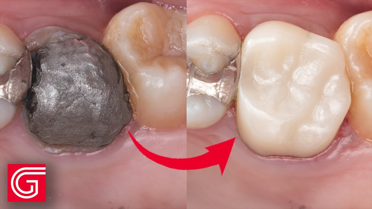 Replacing a Large Silver Filling with Same-Visit Zirconia Crown - YouTube
