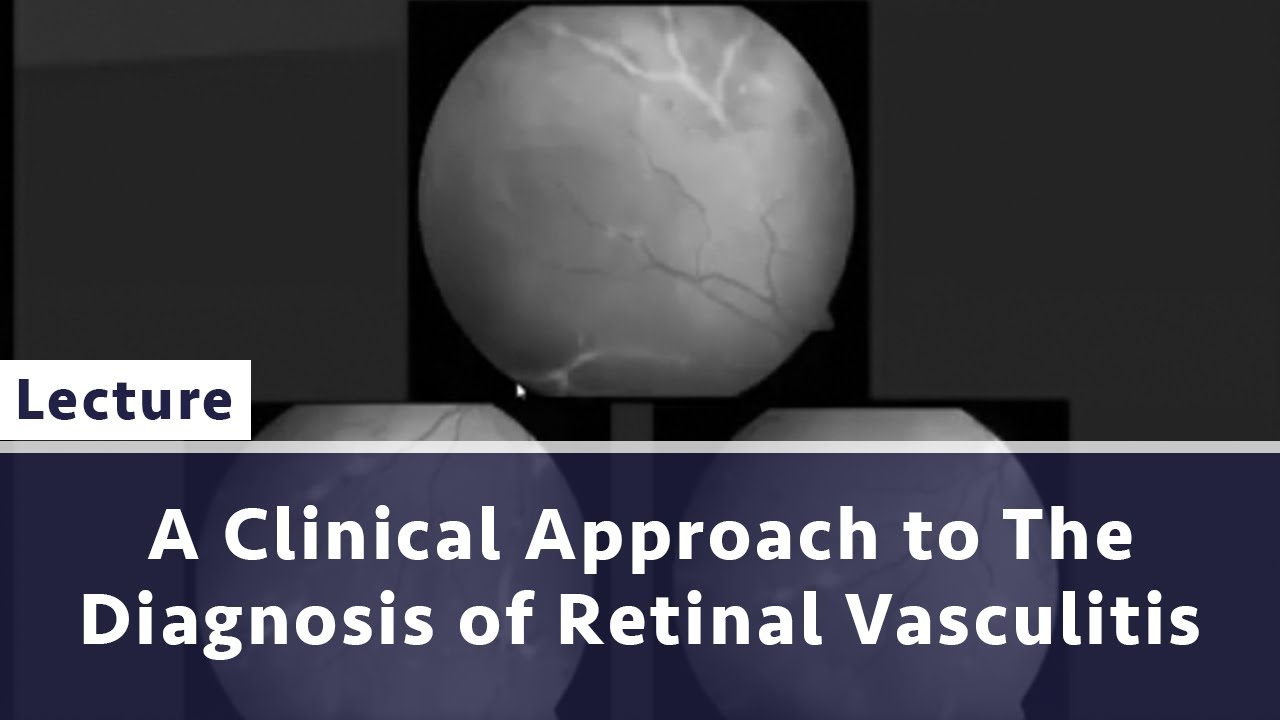 A Clinical Approach to The Diagnosis of Retinal Vasculitis - YouTube