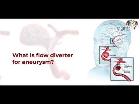 Flow diverter for Aneurysm - YouTube