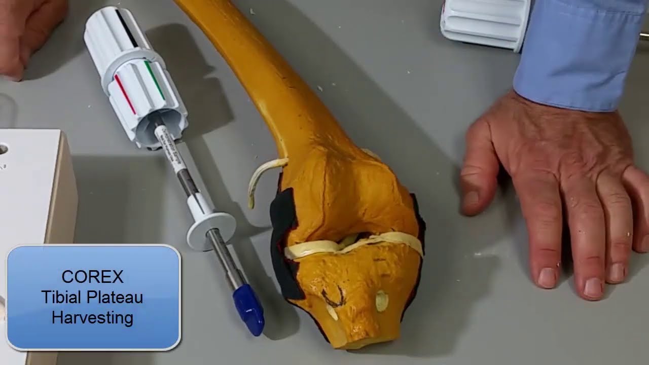 COREX™ | Proximal Tibia Bone Graft Harvest - Approach - YouTube