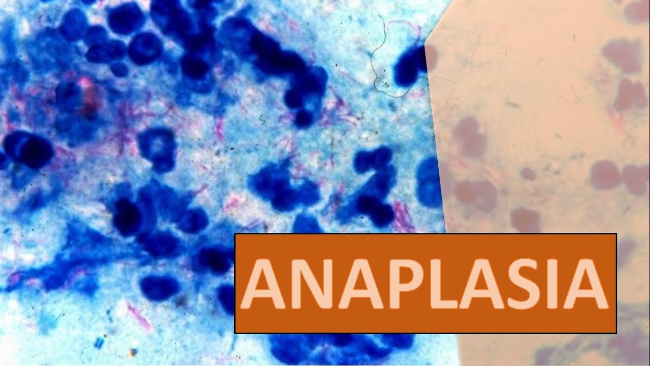 Anaplasia / PATOLOGIA #1 - YouTube