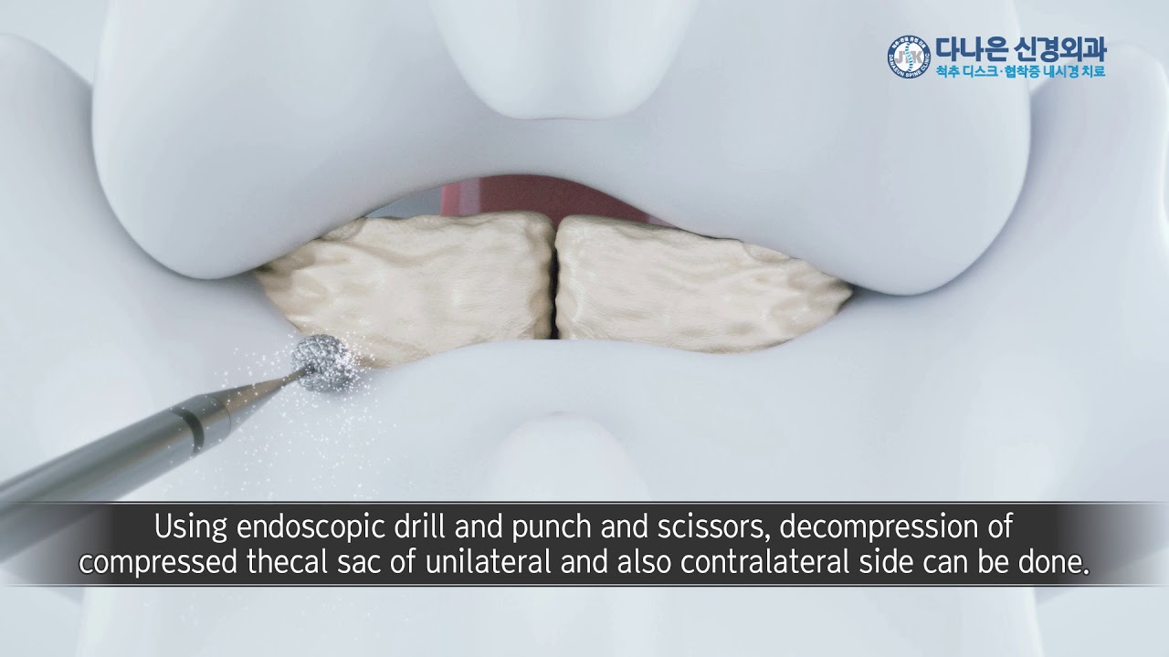Full Endoscopic Uniportal Stenosis Surgery - YouTube