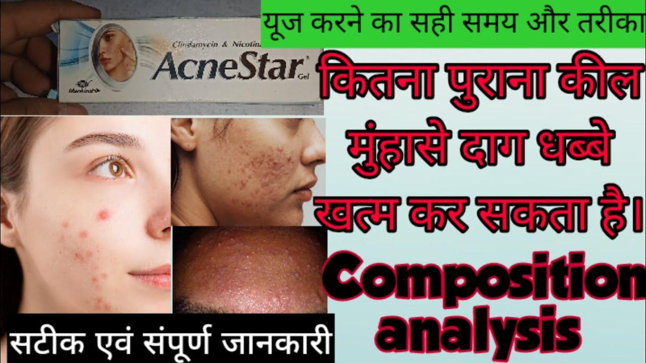 AcneStar cream/Gel ka use। चेहरे पर कील मुहासे फोड़ा फुंसी काले धब्बे ...