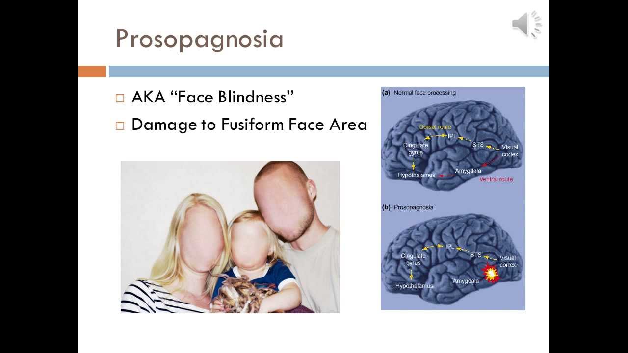 Bio 33 Project: Agnosia - YouTube