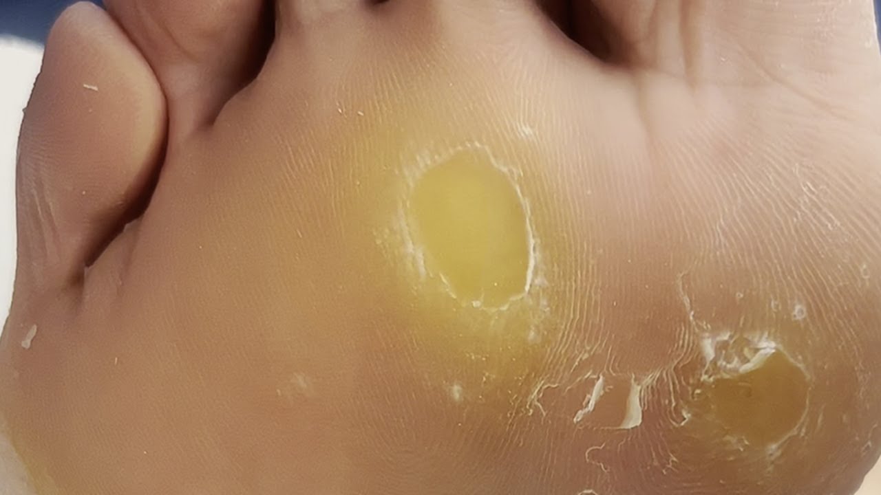 Yellow foot calluses, the process of removal is very healing【Xue Yidao ...