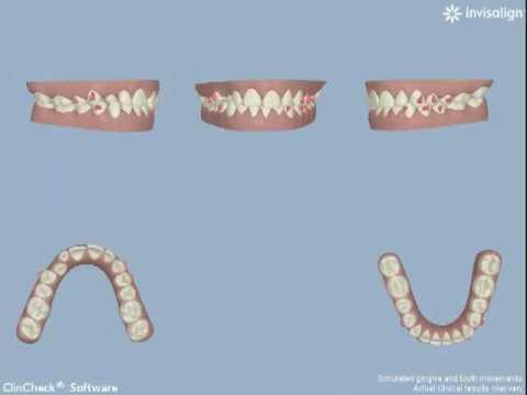 Invisalign Teen - UR3 and Power Ridges, Lingually Erupting.mp4 - YouTube