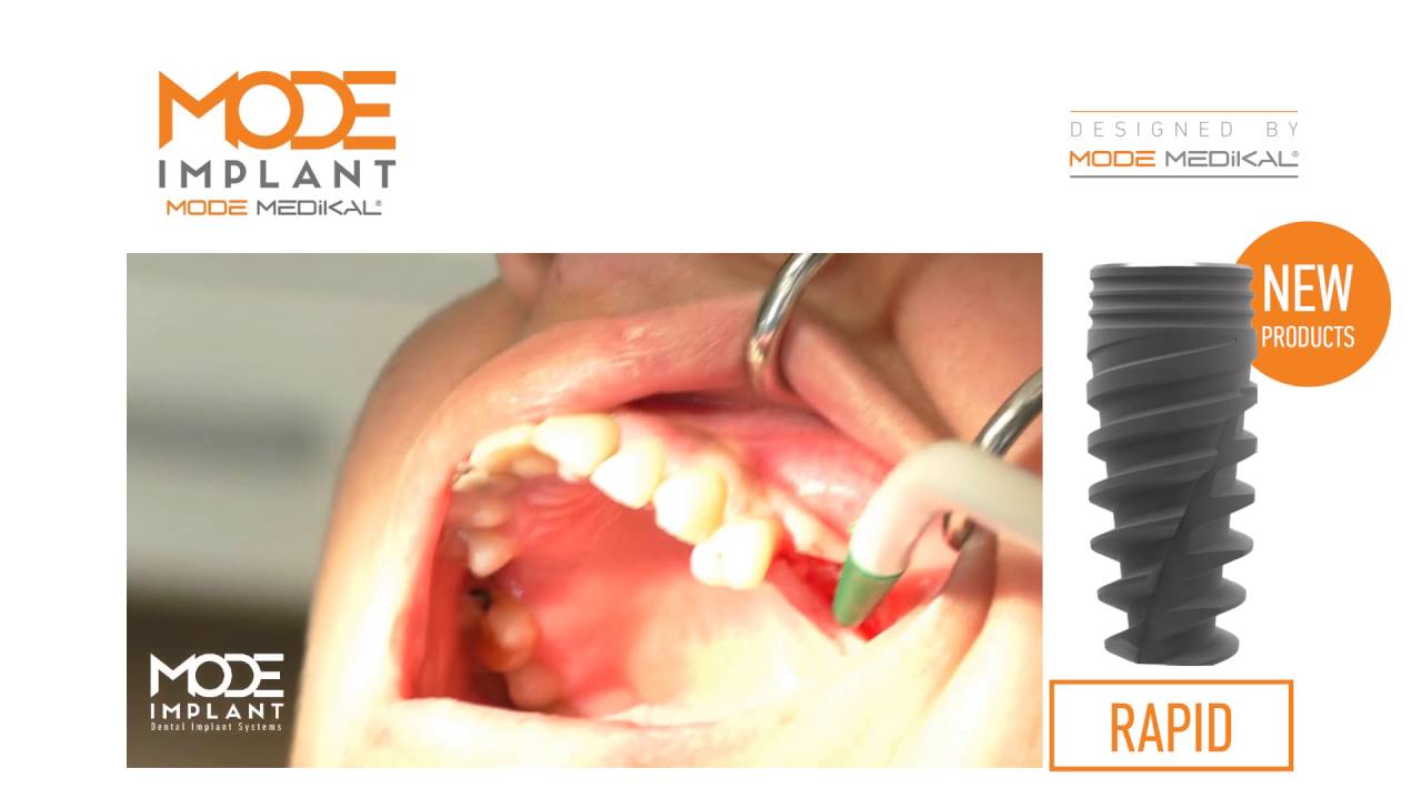 Mode RAPID Implant - YouTube