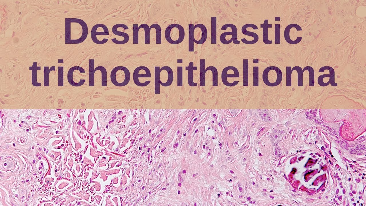 Desmoplastic Trichoepithelioma - Pathology mini tutorial - YouTube