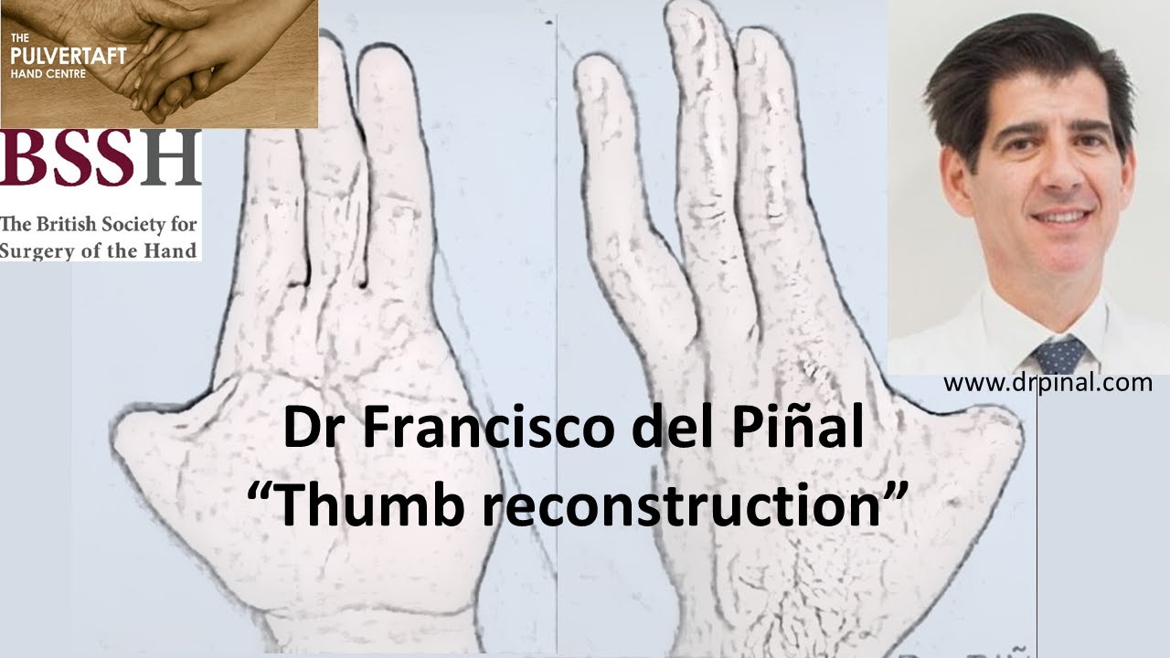 Thumb reconstruction by Dr Francisco del Pinal - YouTube