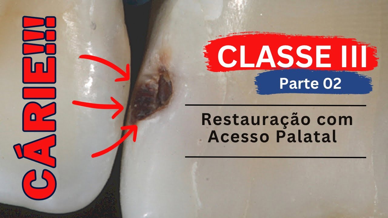 Restauração Classe III - Parte 02 - Acesso Palatal - YouTube