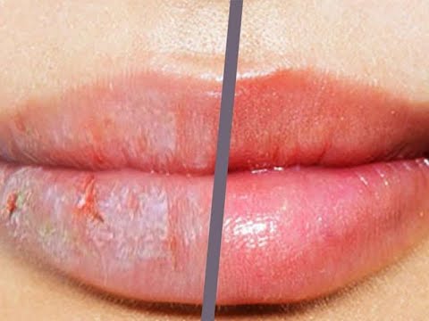 8 gjërat që buzët përpiqen t’ju thonë për shëndetin tuaj!