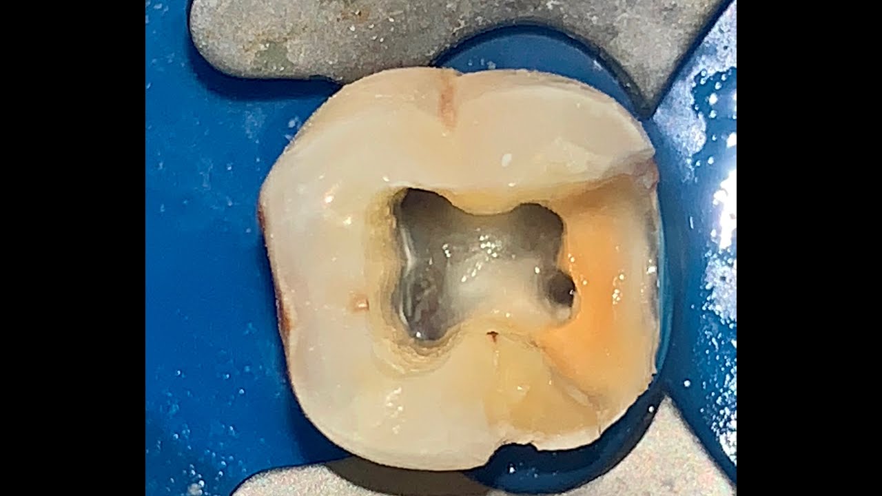 Mandibular Molar Access Opening - YouTube