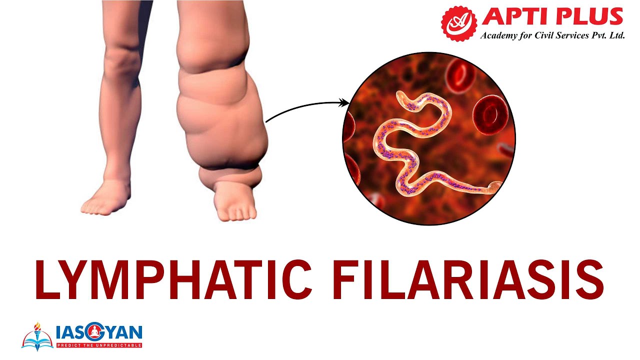 Lymphatic Filariasis - YouTube