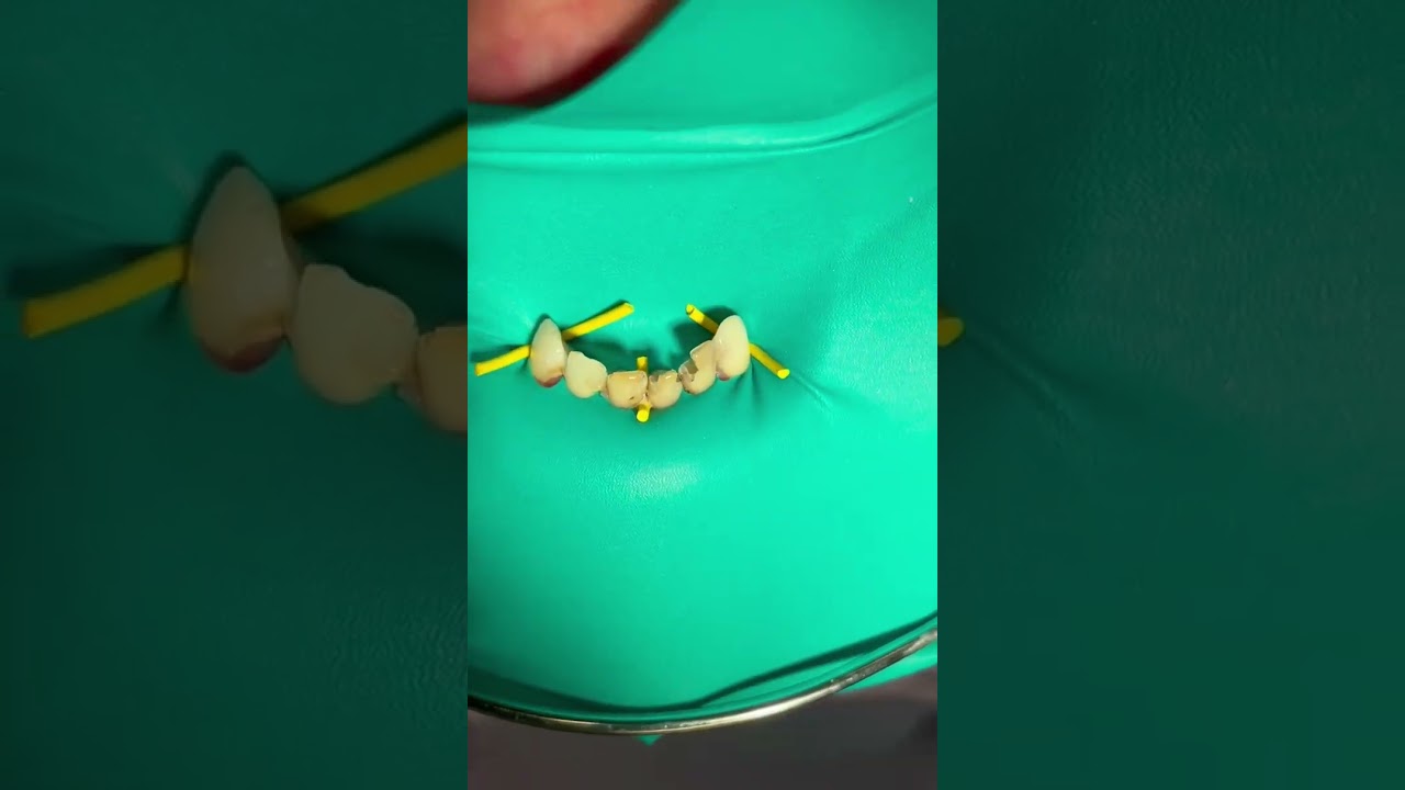 Isolating Teeth For Root Canals With Rubber Dam Rootcanal Dentist Rubberdam