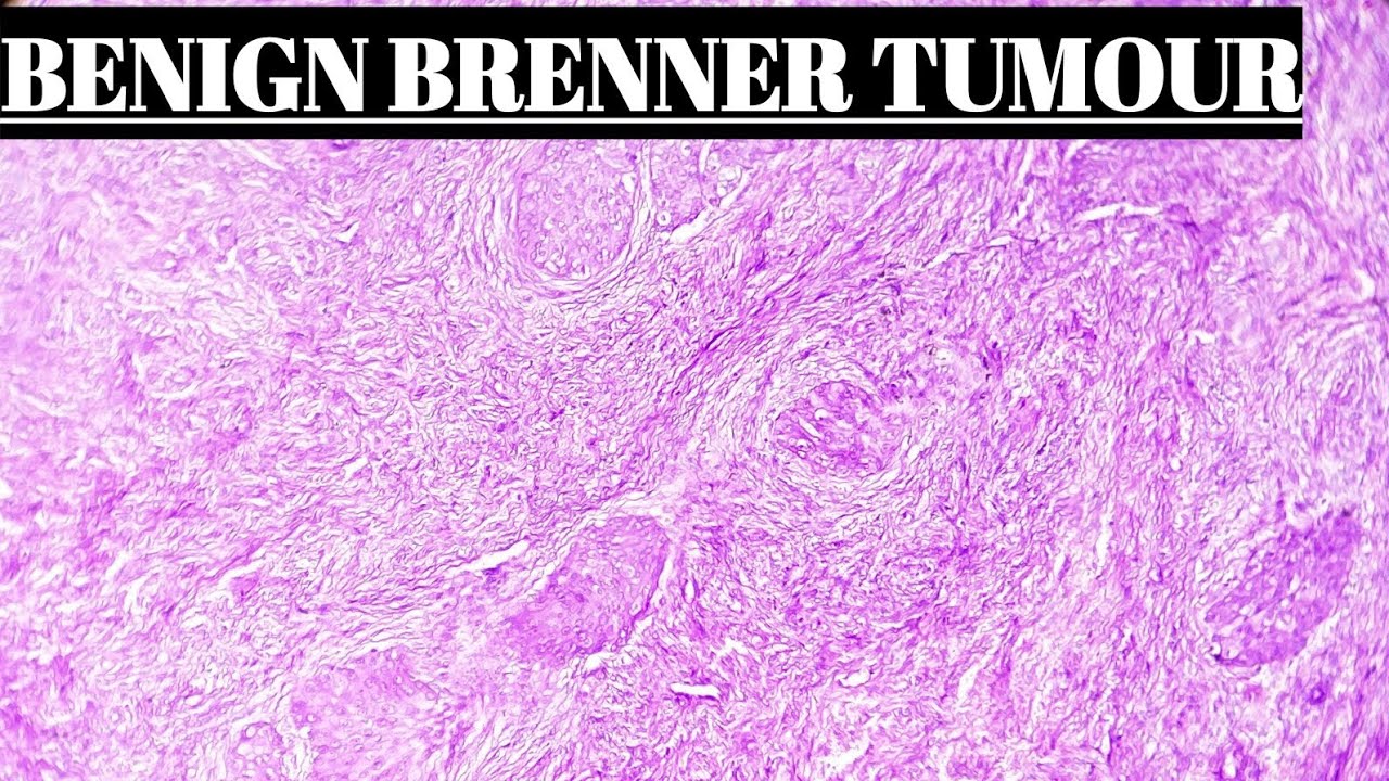 Benign Brenner Tumour Histopathology - YouTube