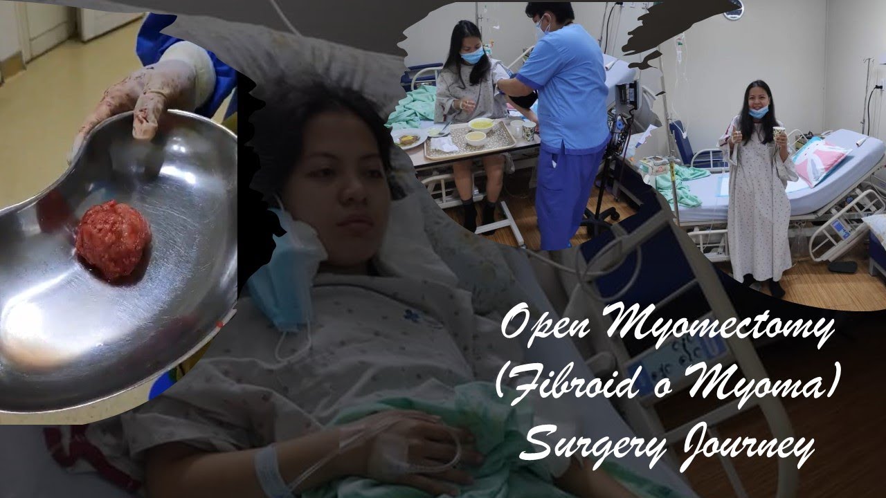 Myoma/ Fibroid Open Myomectomy (Before and After Surgery) - YouTube