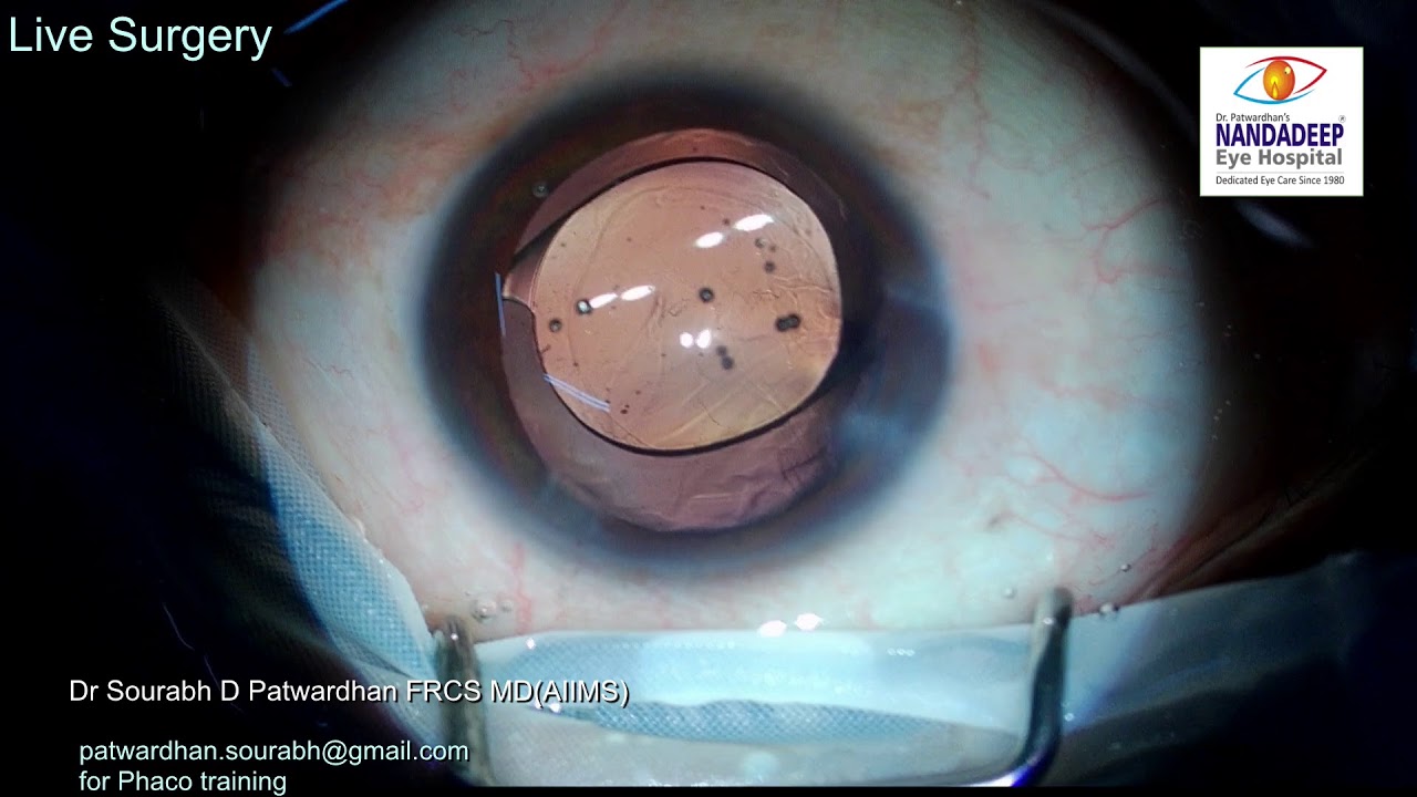 Live surgery from Nandadeep Eye Hospital Dr Sourabh Patwardhan - YouTube