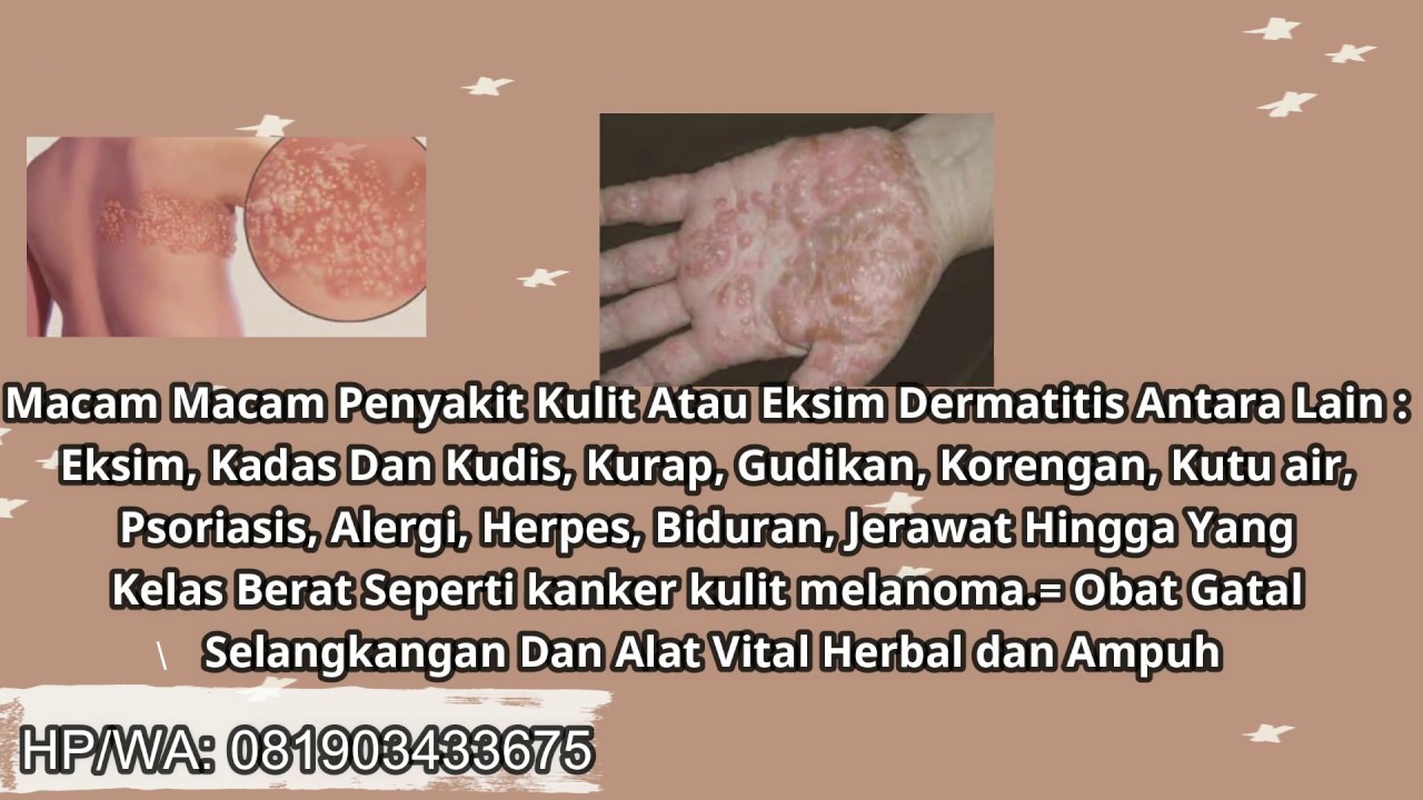 Pil Obat Gatal Selangkangan Paling Mujarab - YouTube