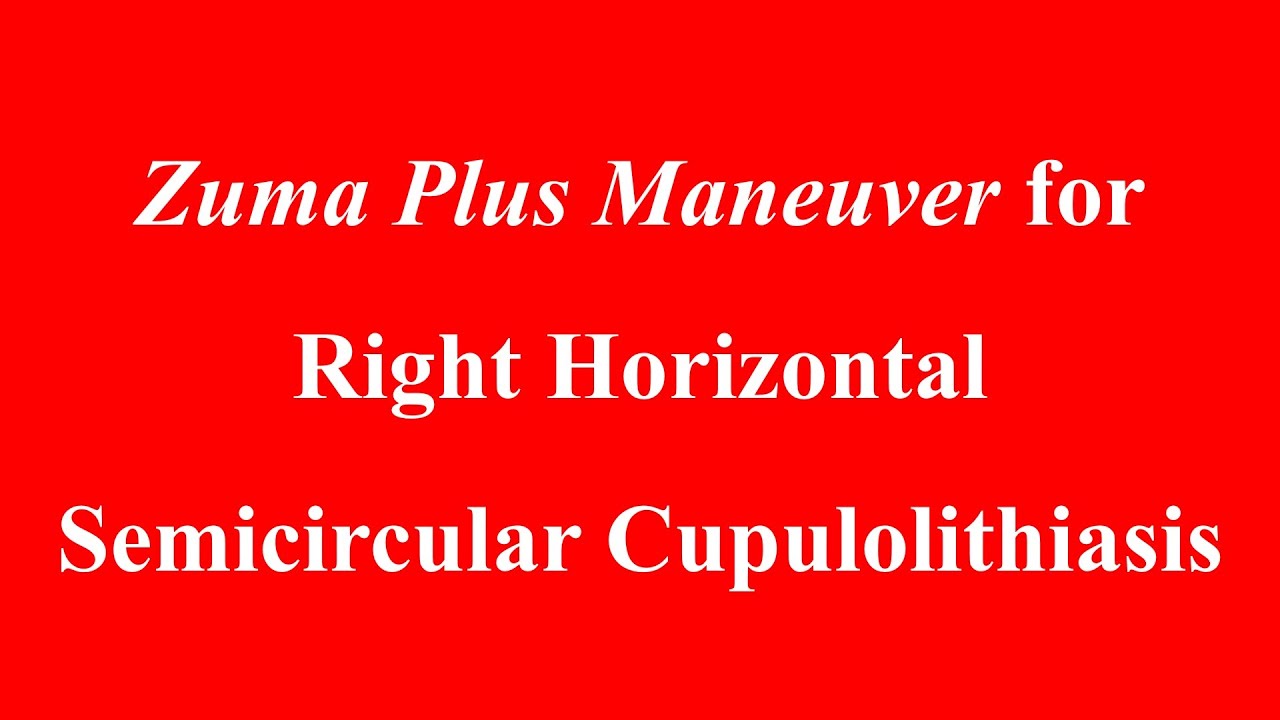 Zuma Plus Maneuver for Right Horizontal Semicircular Cupulolithiasis ...